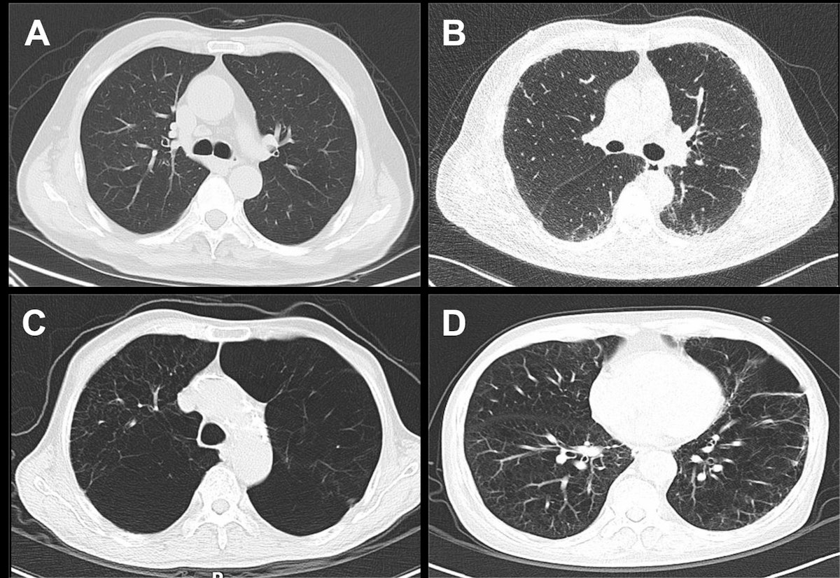 Interstitial Lung Abnormality In Copd Is Inversely Associated With Comorbidity Of Lung Cancer