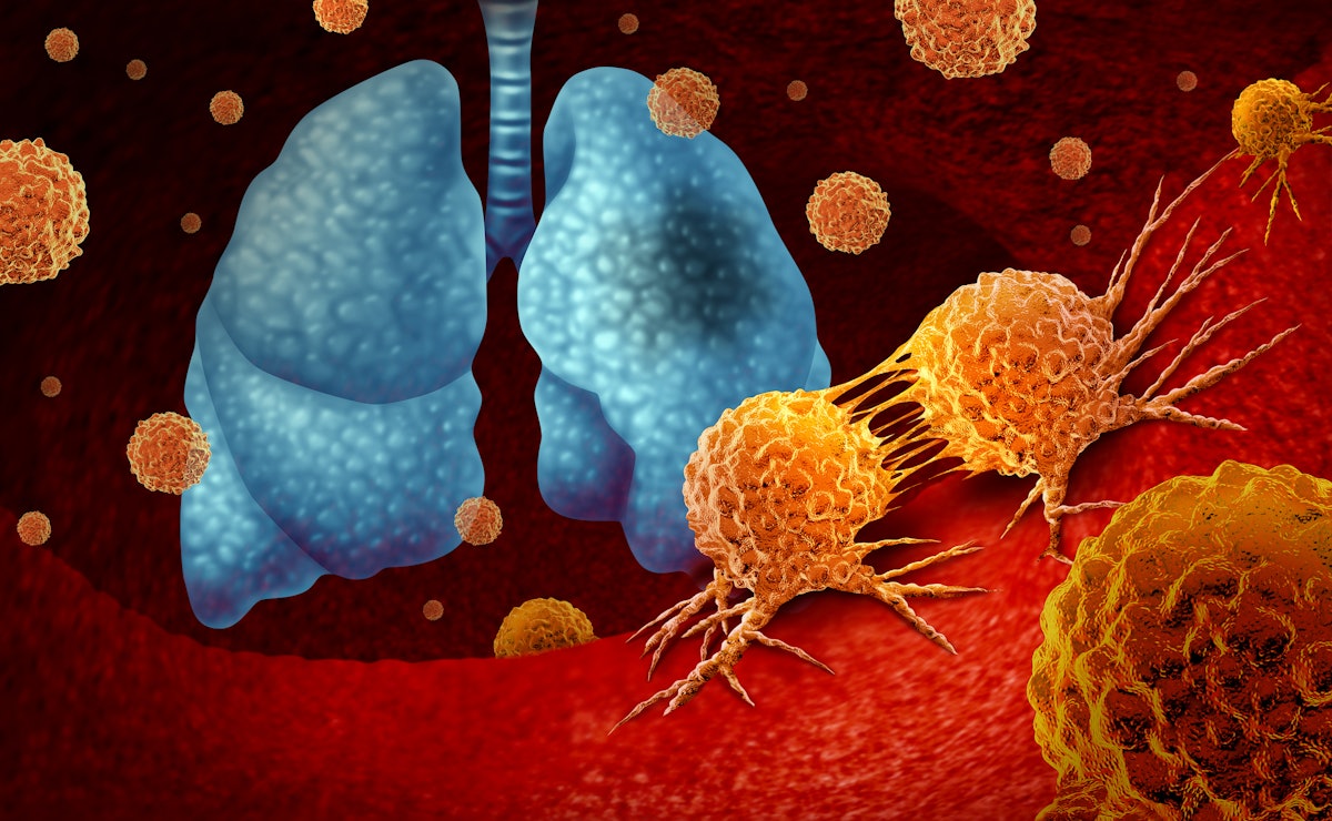 What fuels aggressive lung cancer? | Pulmonary