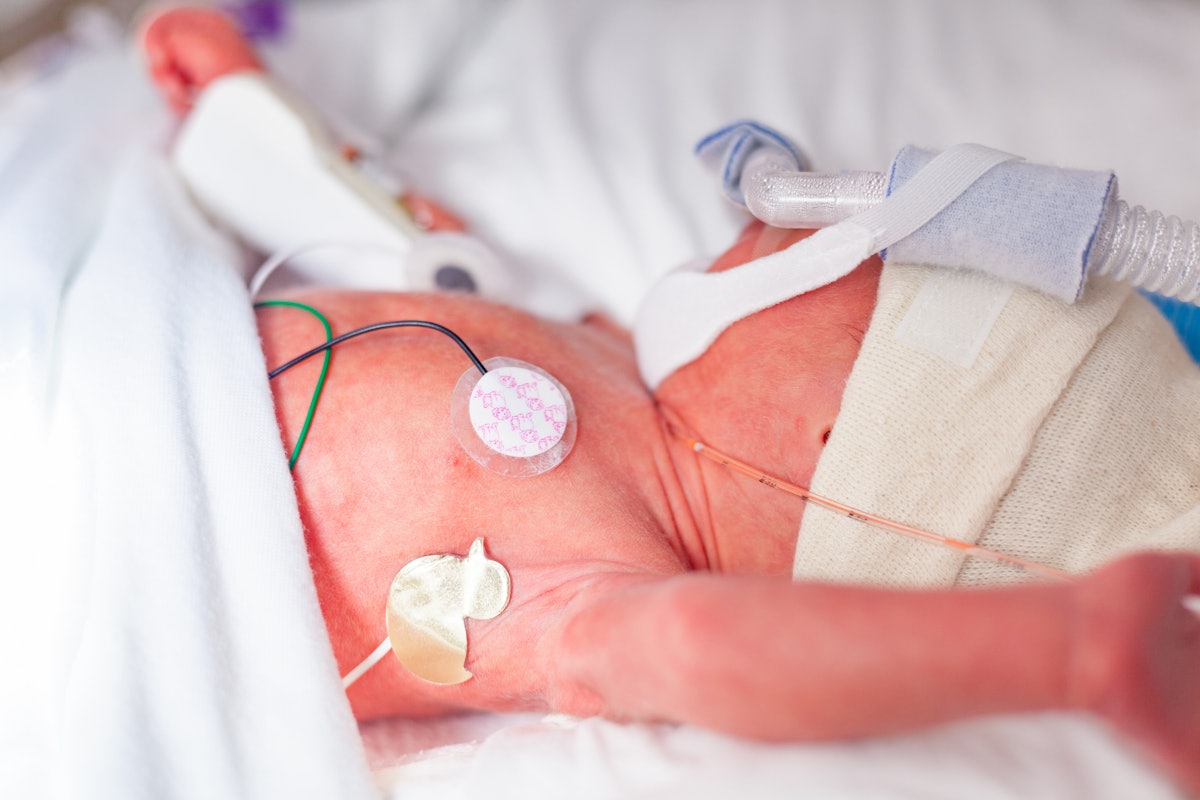 Adapted CPAP approach helps preterm infant lung growth, function ...