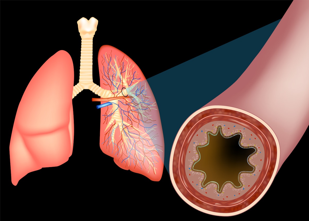mucus plug lung causes